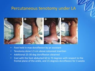 Management of club foot | PPTX