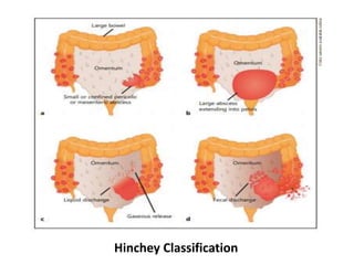 Management of colon diverticular disease | PPTX