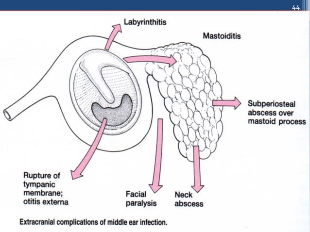 Management of complications of acute otitis media | PDF