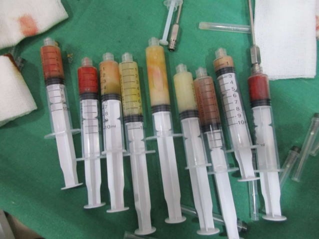 Management of complications of dermal fillers implant | PPTX