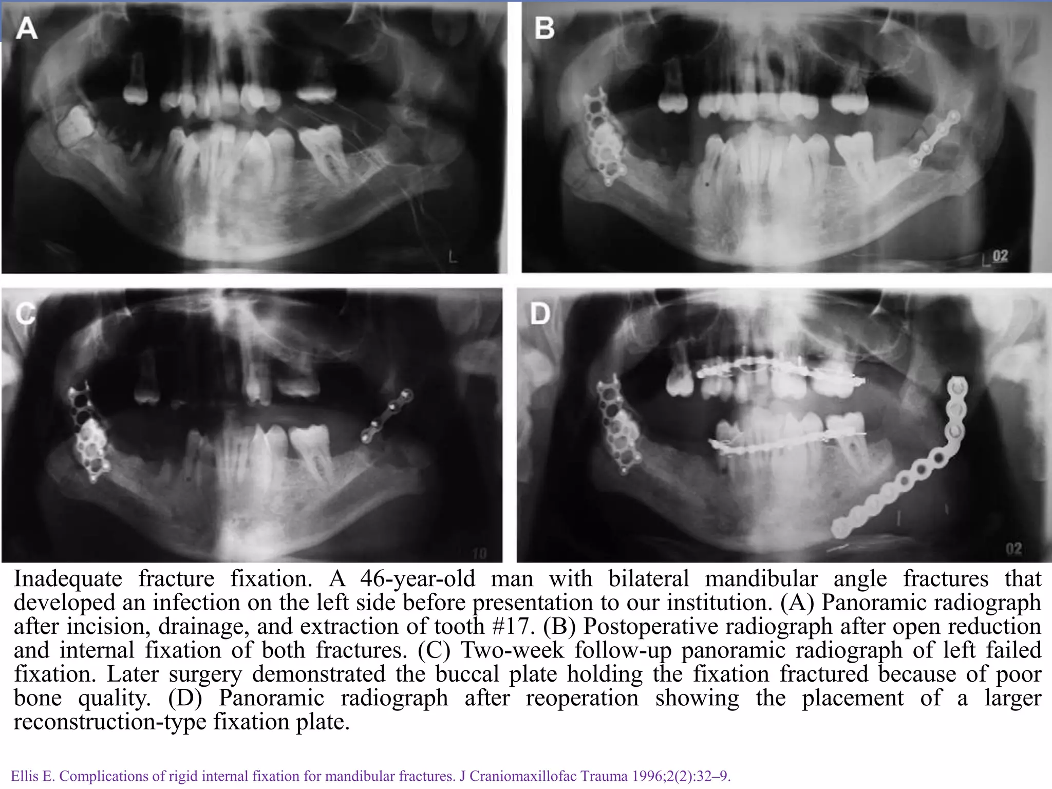 Management of complications of mandibular trauma | PPTX