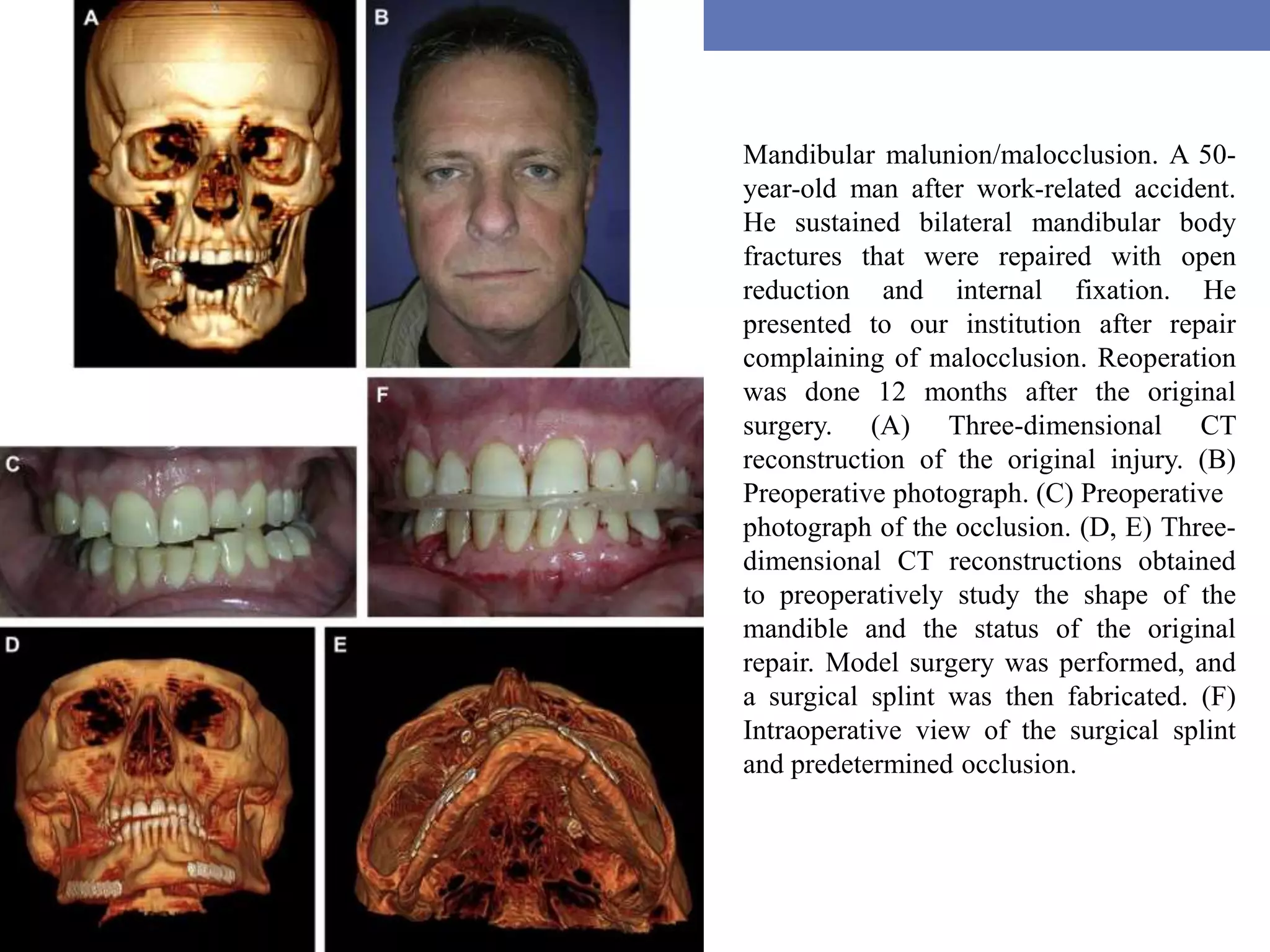 Management of complications of mandibular trauma | PPTX
