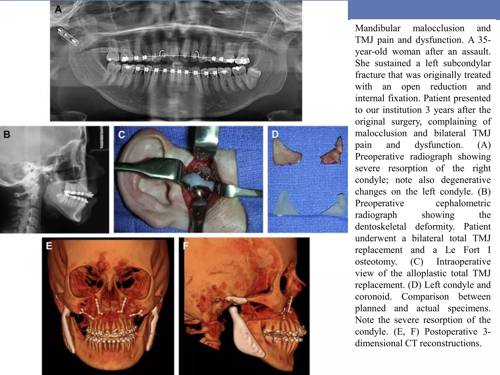 Management of complications of mandibular trauma | PPTX