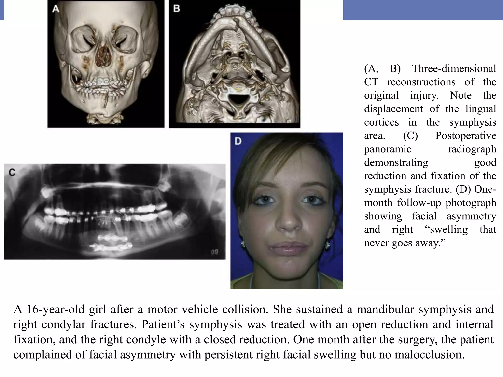 Management of complications of mandibular trauma | PPTX