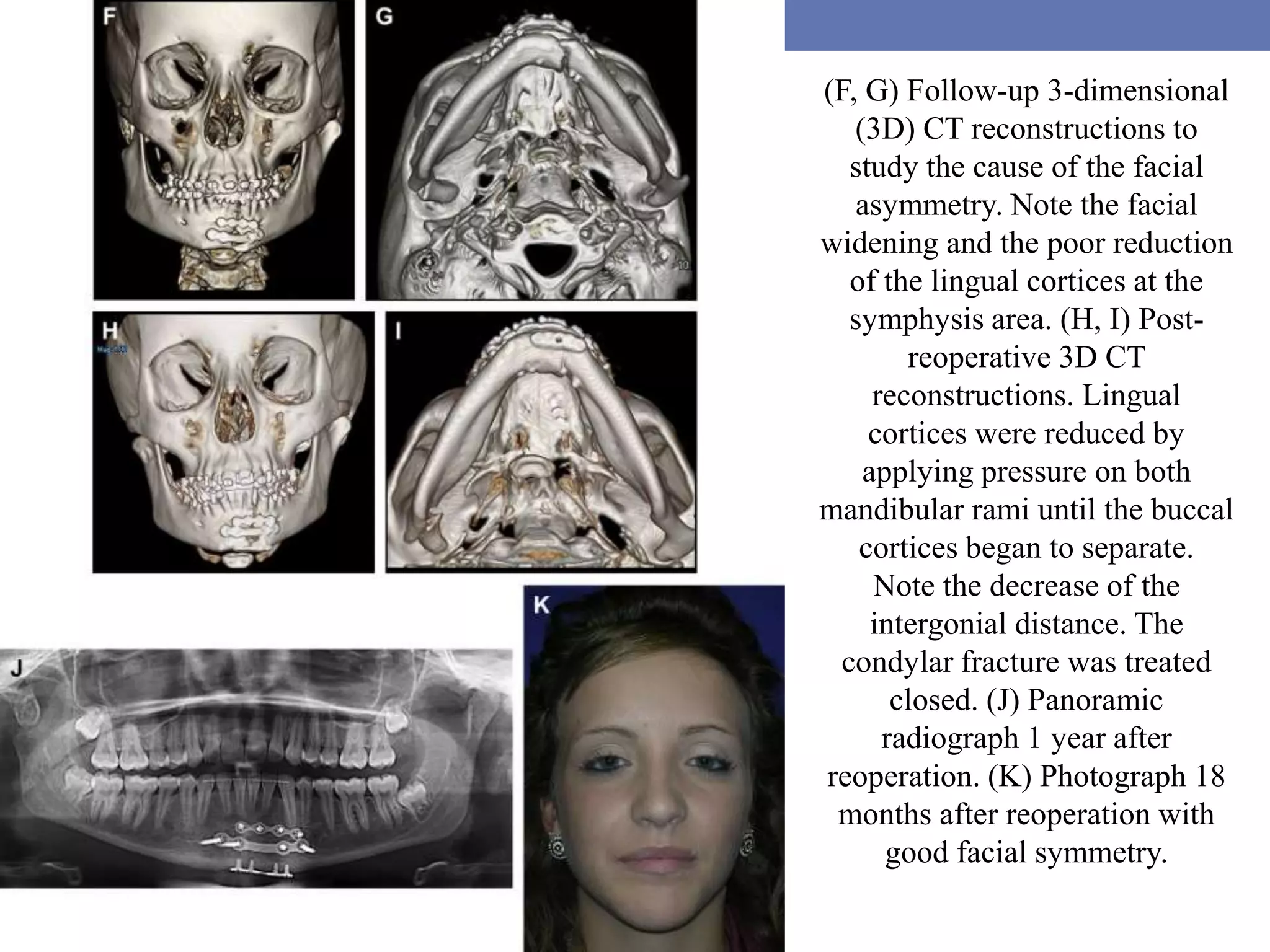 Management of complications of mandibular trauma | PPTX