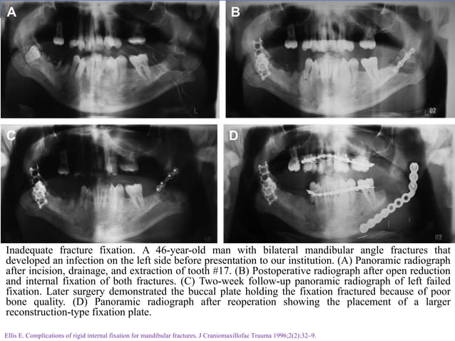 Management of complications of mandibular trauma | PPTX | Bone and ...