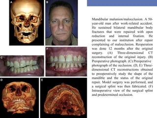 Management of complications of mandibular trauma | PPTX