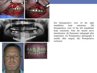 Management of complications of mandibular trauma | PPTX