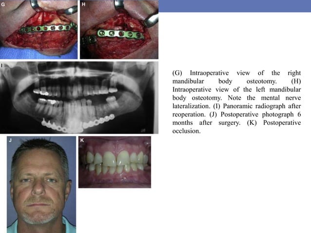 Management of complications of mandibular trauma | PPTX | Bone and ...