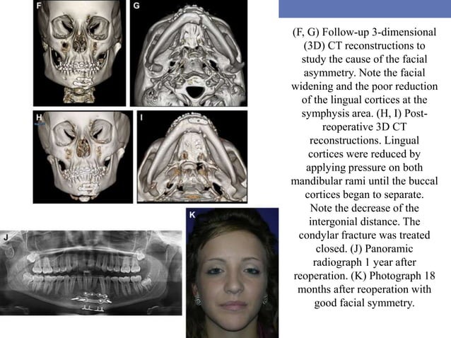 Management of complications of mandibular trauma | PPTX | Bone and ...
