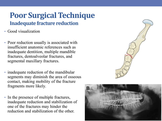 Management of complications of mandibular trauma | PPTX | Bone and ...
