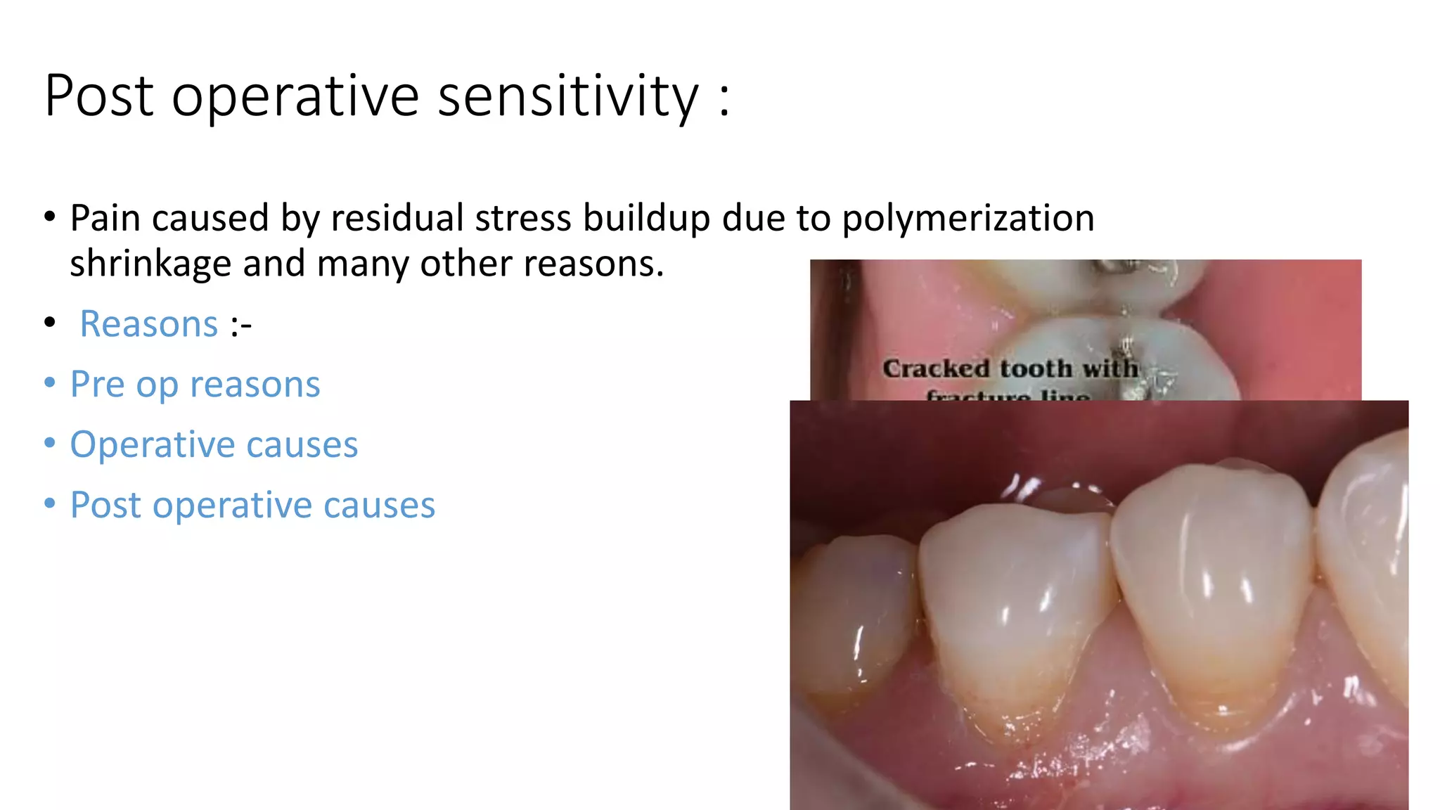 Management of composite sensitivity | PPTX