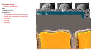 Management of composite sensitivity | PPTX