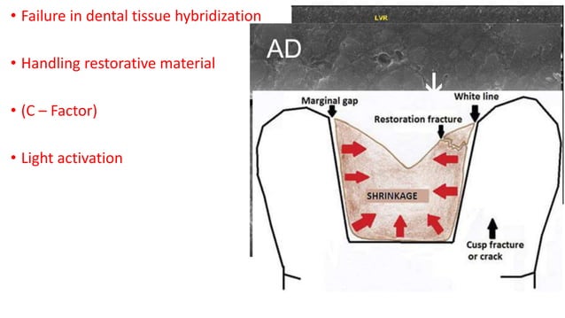 Management of composite sensitivity | PPTX