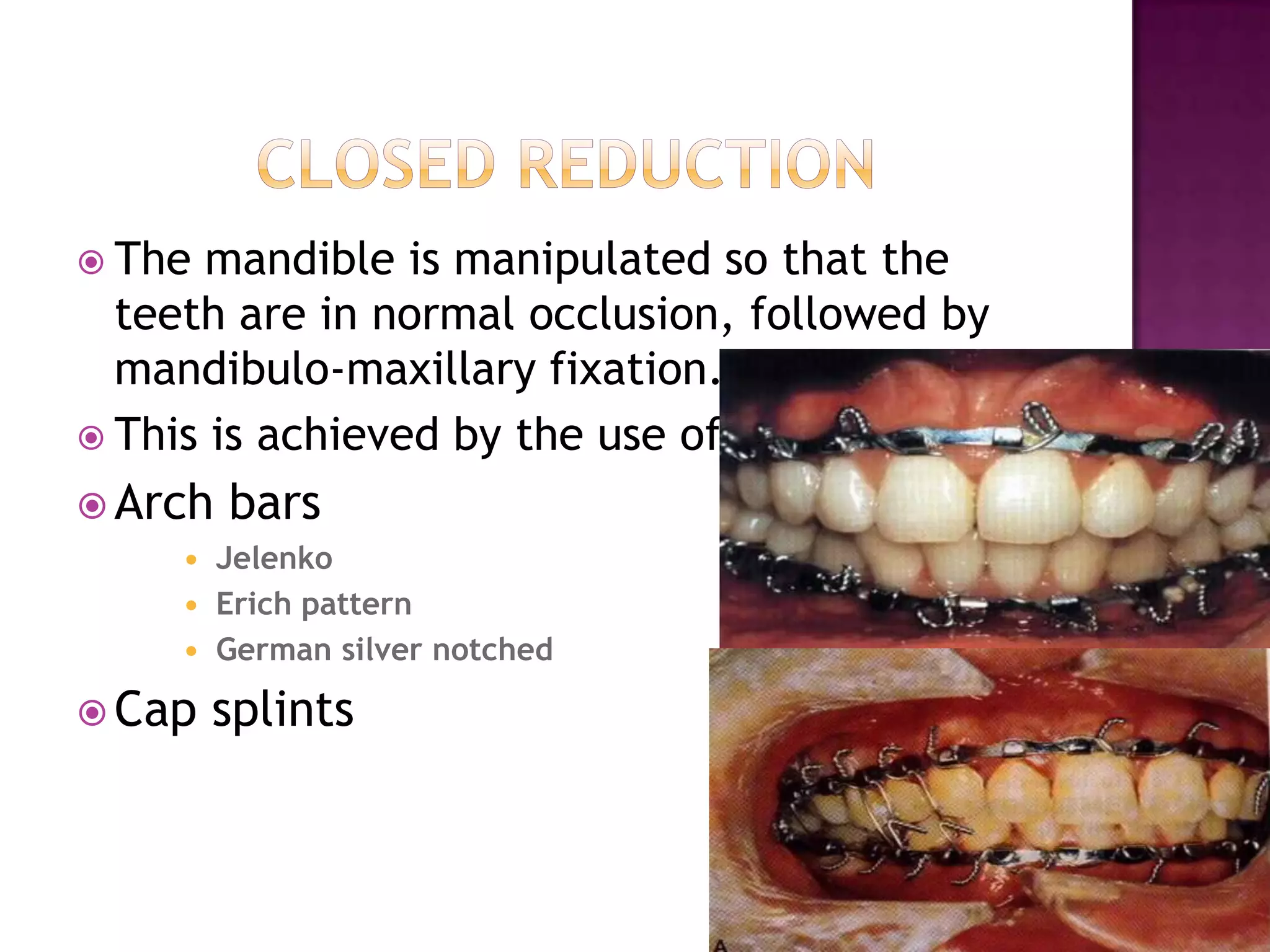 Management of condylar fractures | PPTX