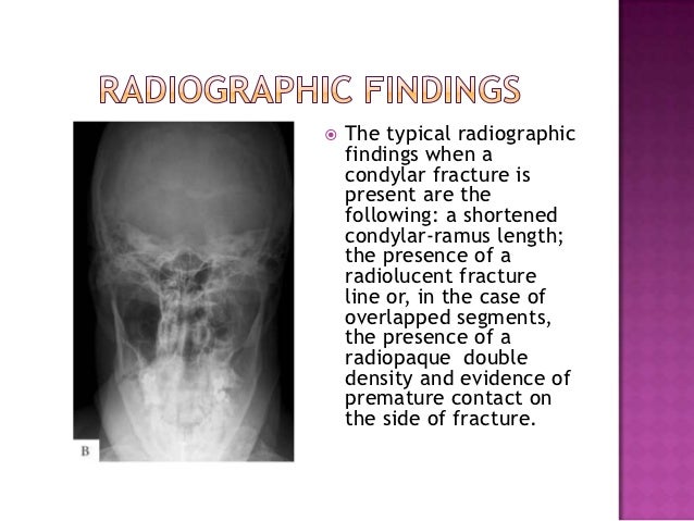 Management of condylar fractures