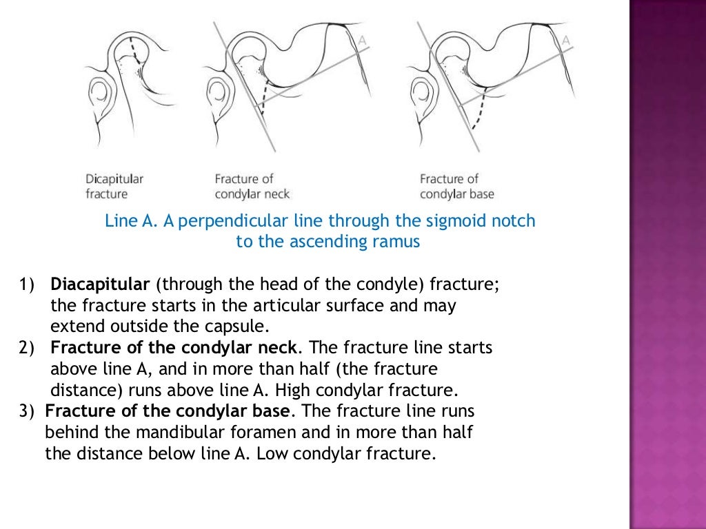 Management of condylar fractures