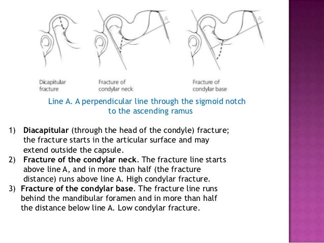 Management of condylar fractures