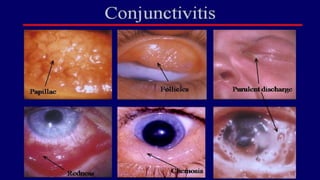 Management of Conjunctivitis | PPTX