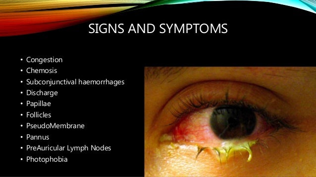 Management of Conjunctivitis