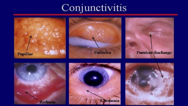 Management of Conjunctivitis
