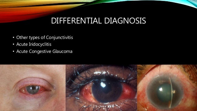 Management of Conjunctivitis