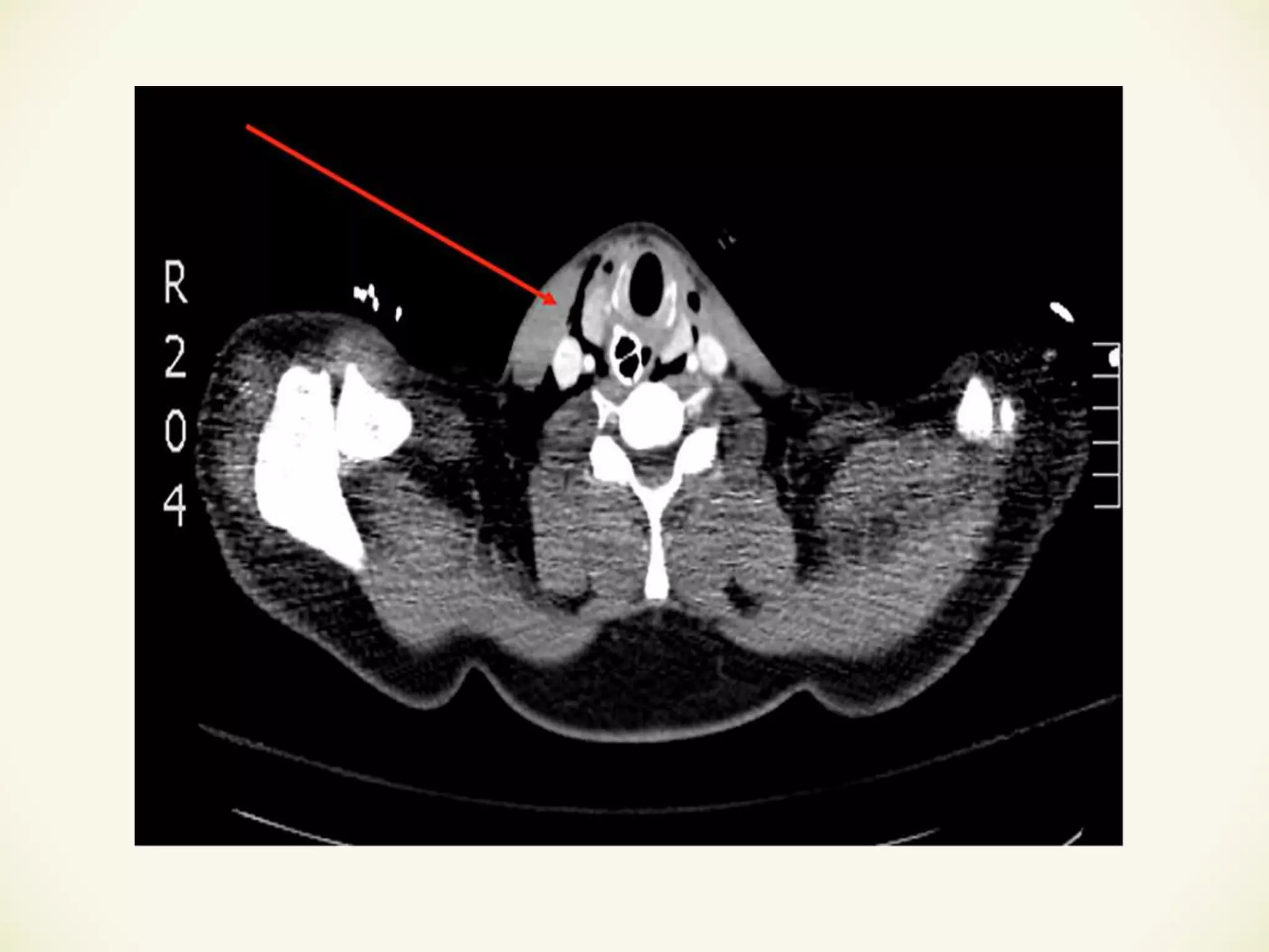 Management of Corrosive injuries - (GD) Disctrict Hospital Nashik.pptx