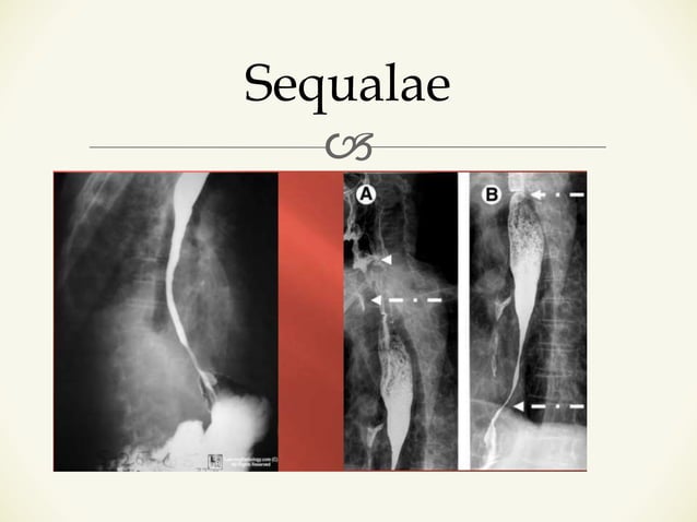 Management of Corrosive injuries - (GD) Disctrict Hospital Nashik.pptx ...