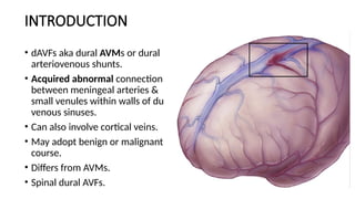 MANAGEMENT OF CRANIAL DURAL ARTEROVENOUS FISTULA.pptx