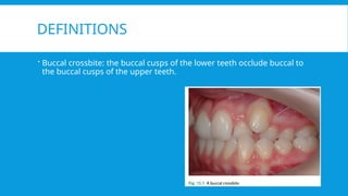 ORTHODONTIC Management of Crossbite.pptx | Free Download