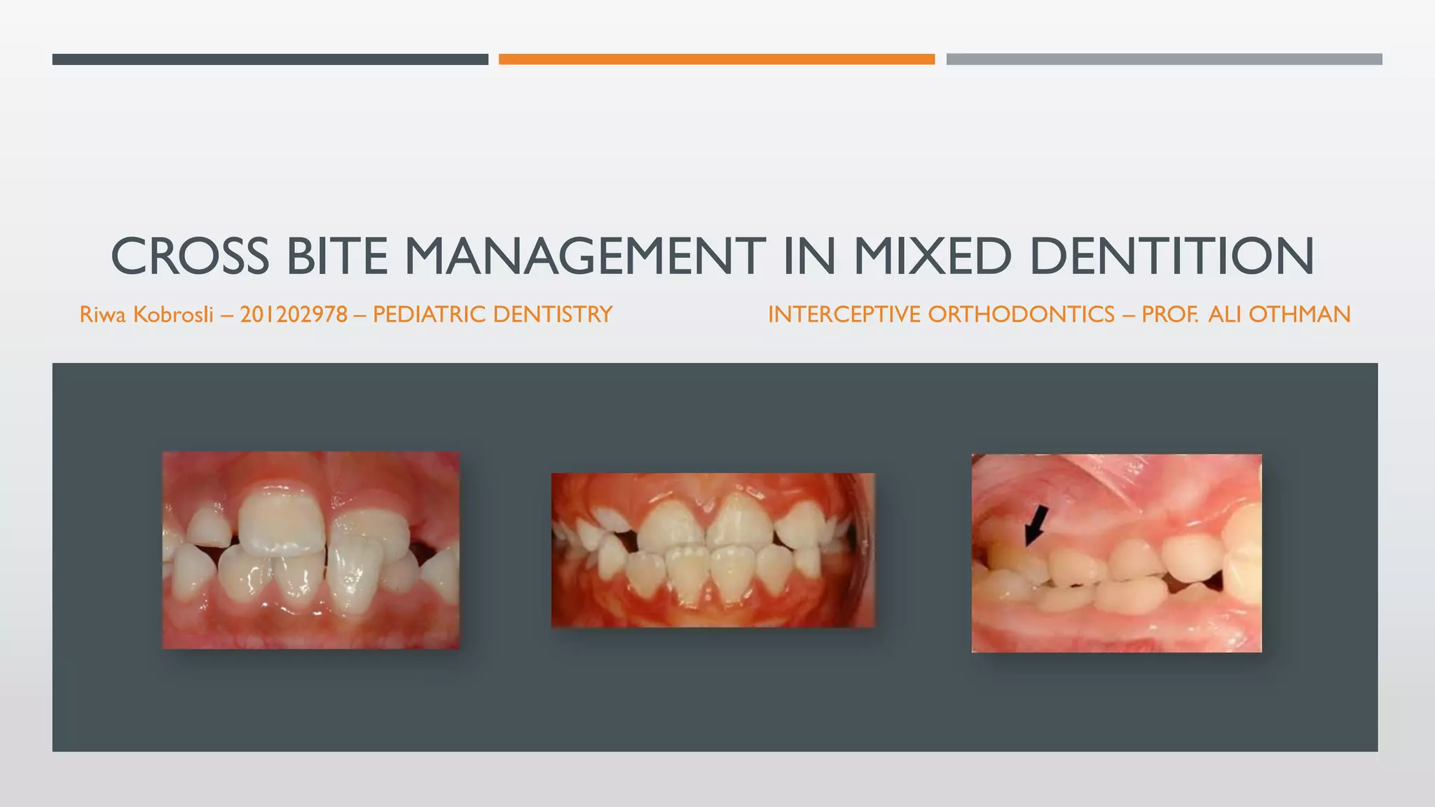 Management of crossbite in mixed dentition | PDF