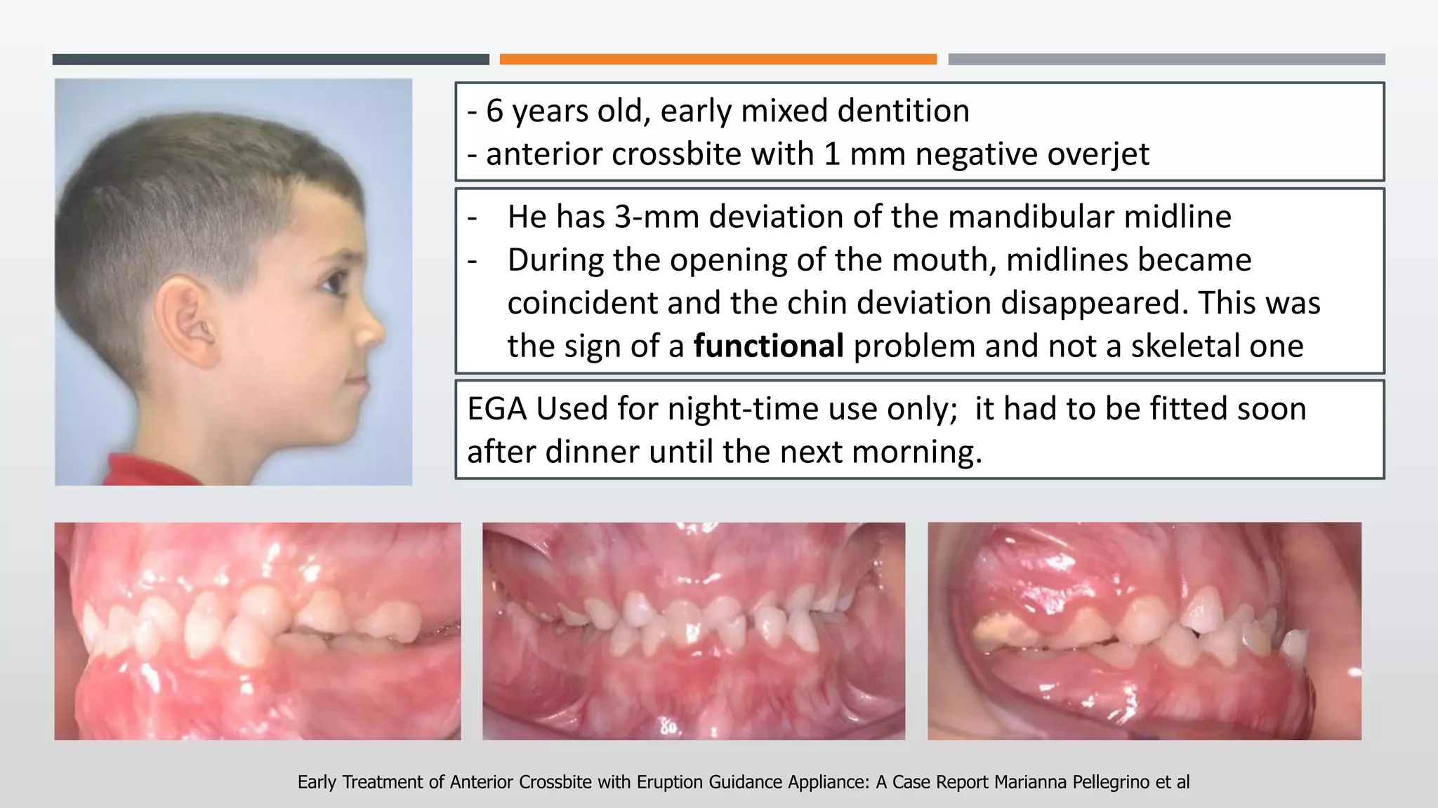Management of crossbite in mixed dentition | PDF