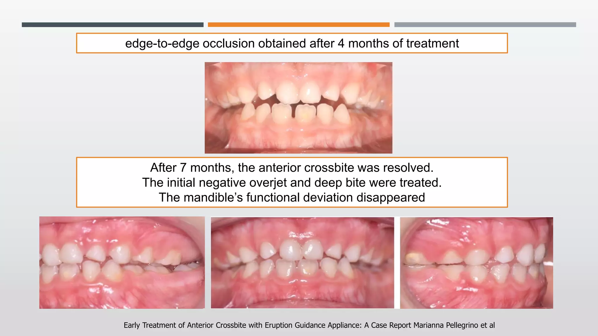 Management of crossbite in mixed dentition | PDF