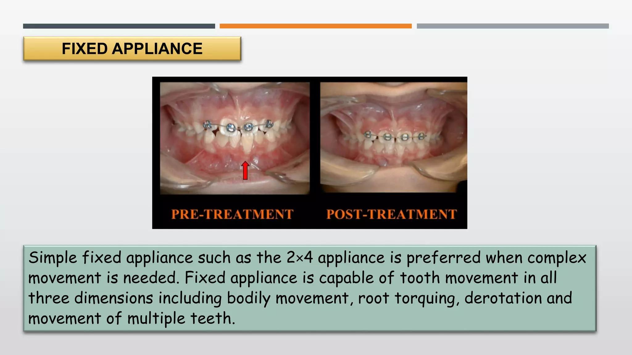 Management of crossbite in mixed dentition | PDF