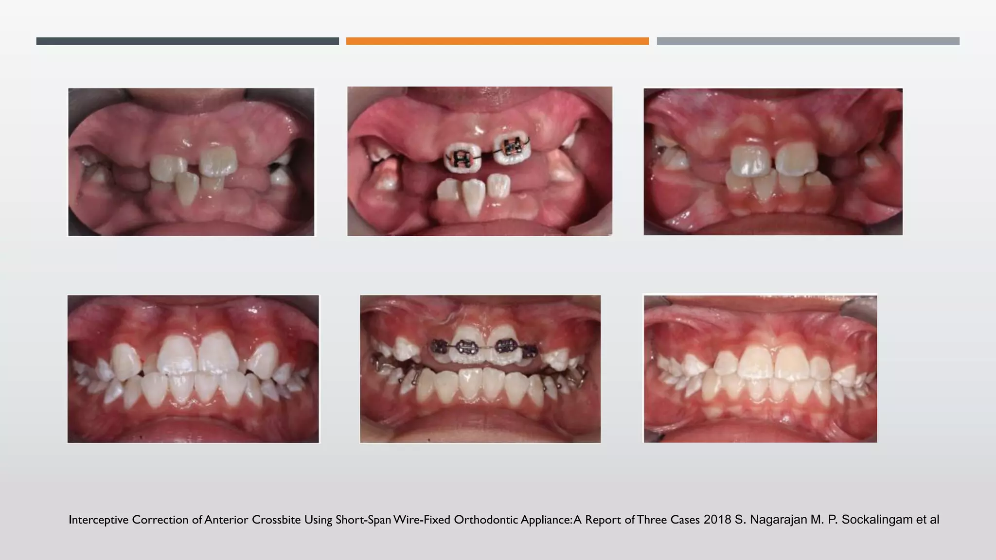 Management of crossbite in mixed dentition | PDF | Dental Health ...