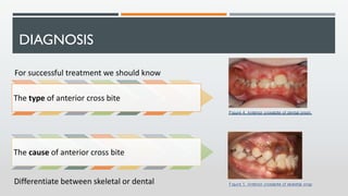 Management of crossbite in mixed dentition | PDF