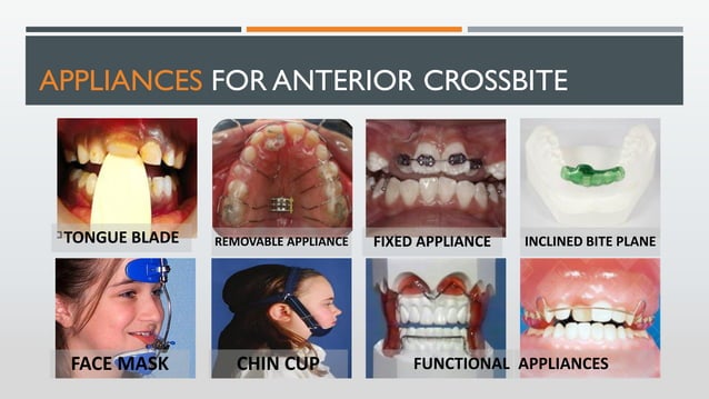 Management of crossbite in mixed dentition | PDF | Dental Health ...