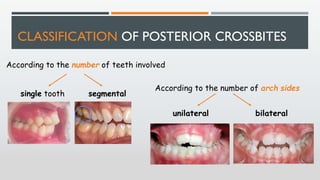Management of crossbite in mixed dentition | PDF