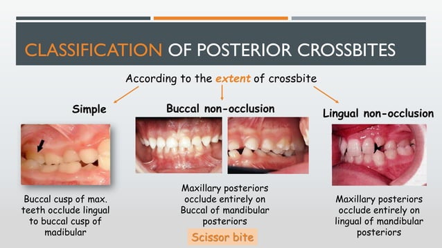 Management of crossbite in mixed dentition | PDF | Dental Health ...