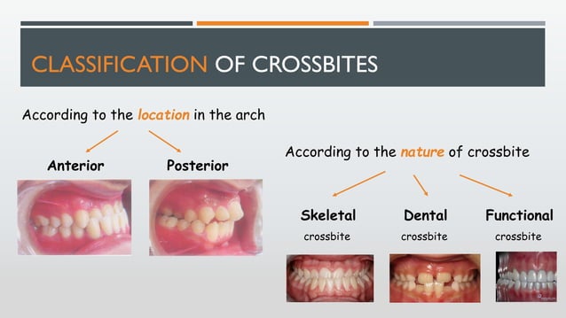Management of crossbite in mixed dentition | PDF | Dental Health ...