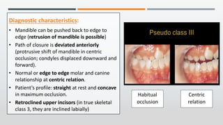 Management of crossbite in mixed dentition | PDF