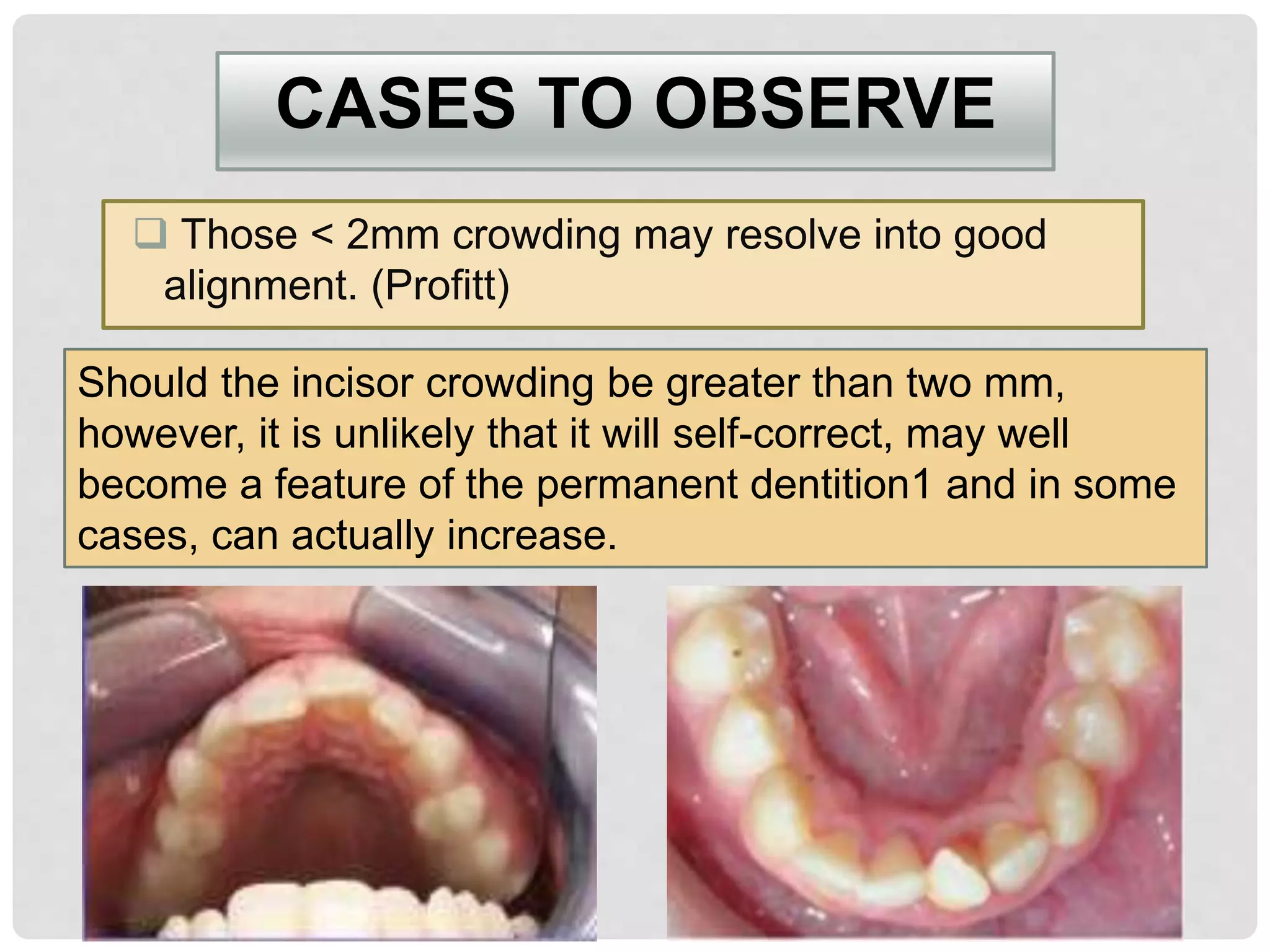 Management of crowded lower incisors | PPTX