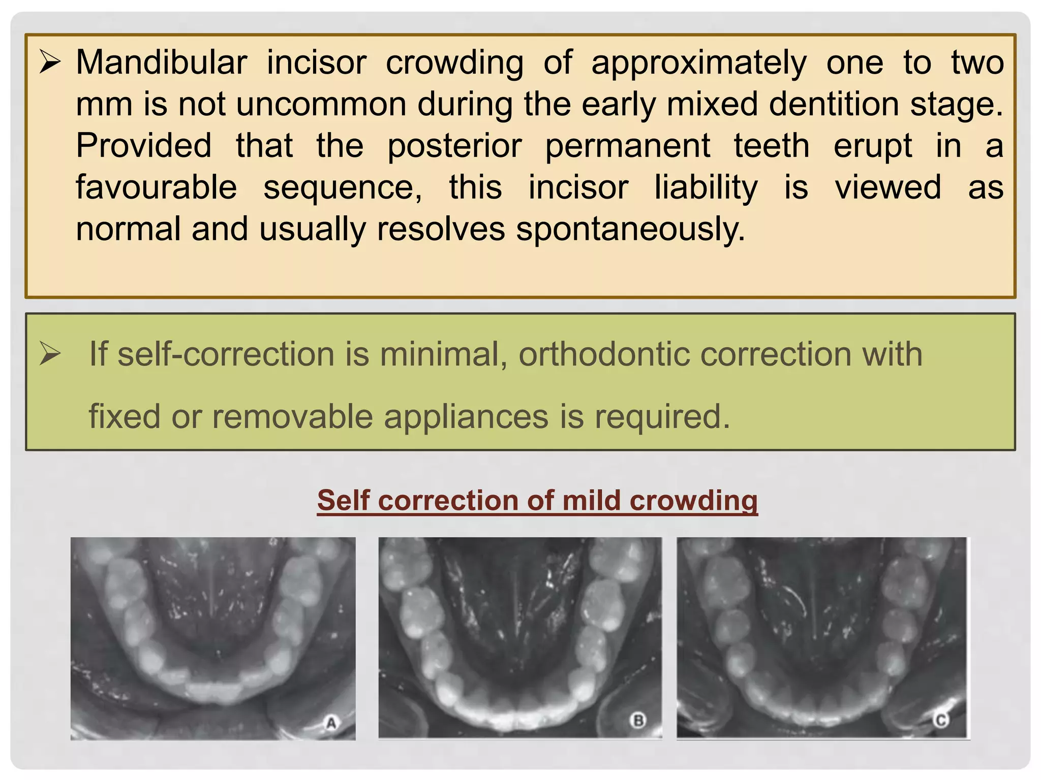 Management of crowded lower incisors | PPTX