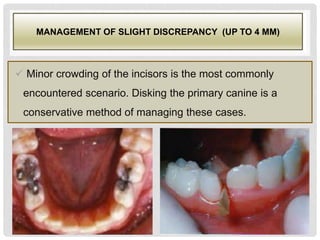 Management of crowded lower incisors | PPTX