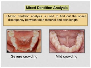 Severe Crowding Teeth