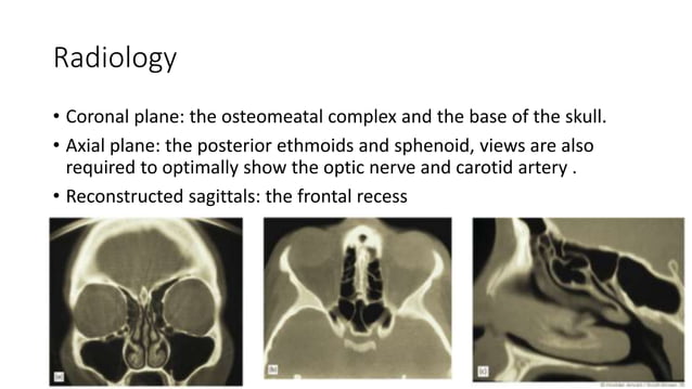 Management of CRS (1).pptx | Ear, Nose and Throat Conditions | Diseases ...