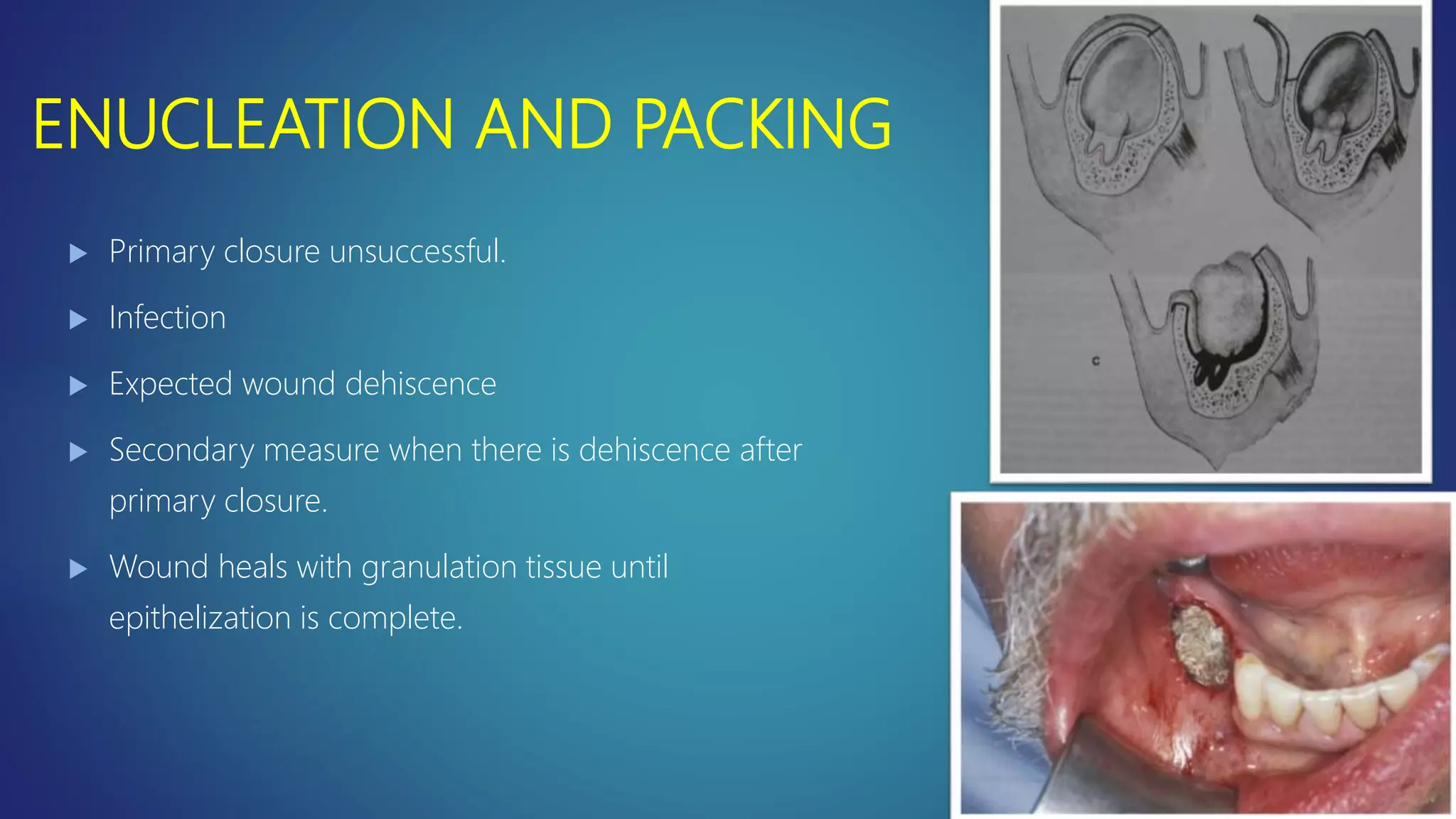 Management of cyst | PPTX