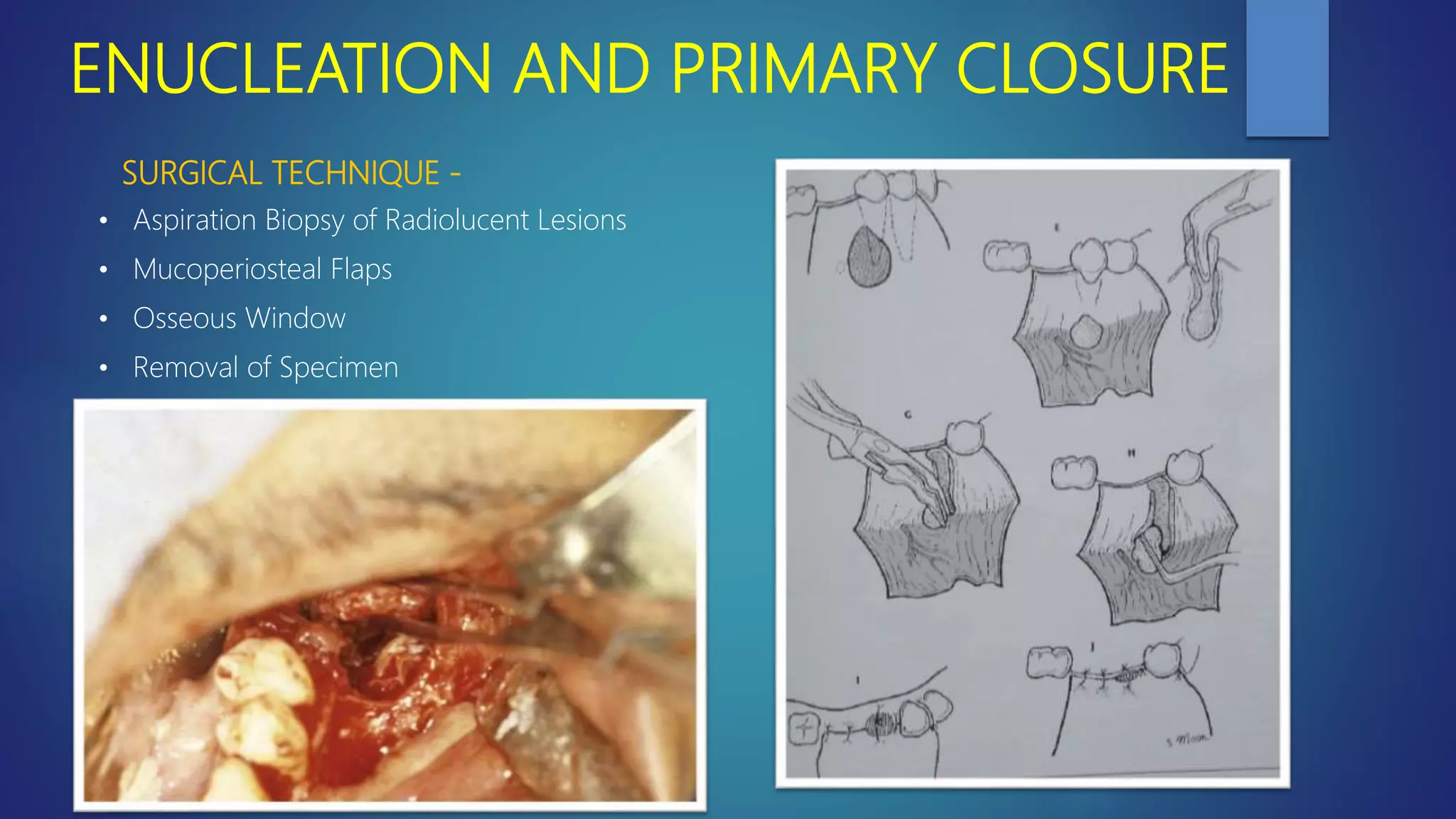 Management of cyst | PPTX