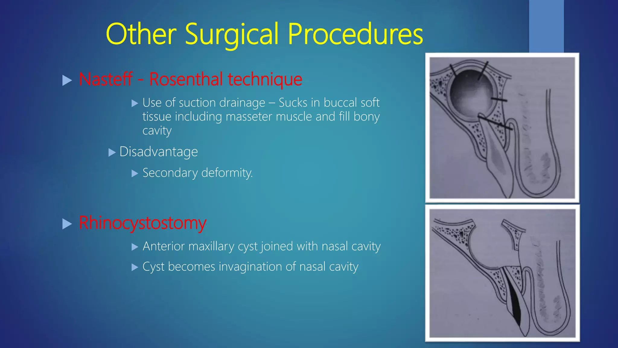 Management of cyst | PPTX