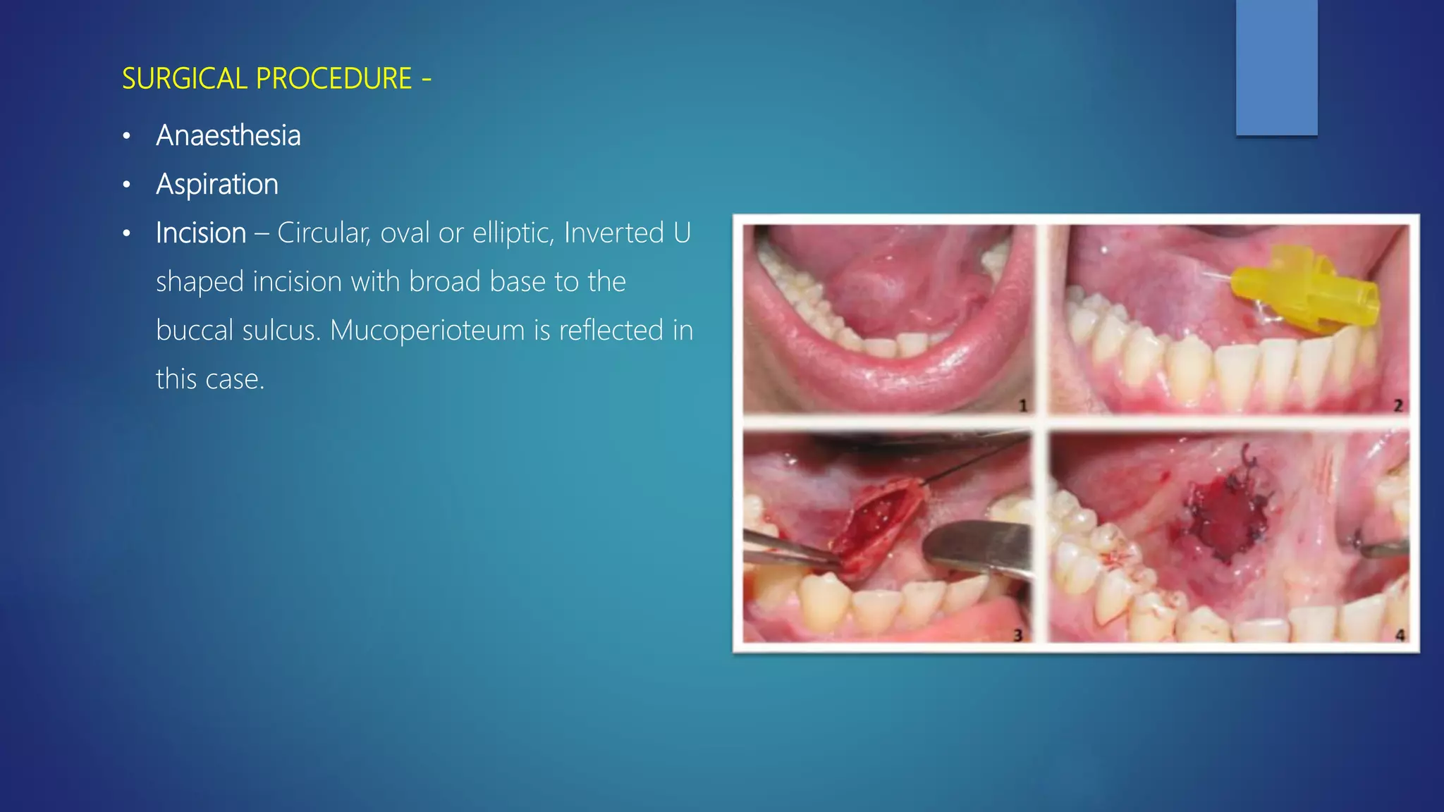 Management of cyst | PPTX
